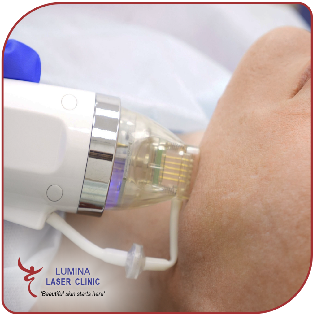 RF skin needling - Lumina Laser Clinic